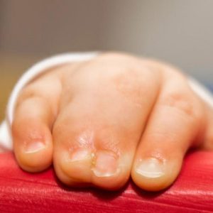 Συνδακτυλίες - Δρ. Αδάμος Σ. Σάββα - Πλαστικός Χειρουργός